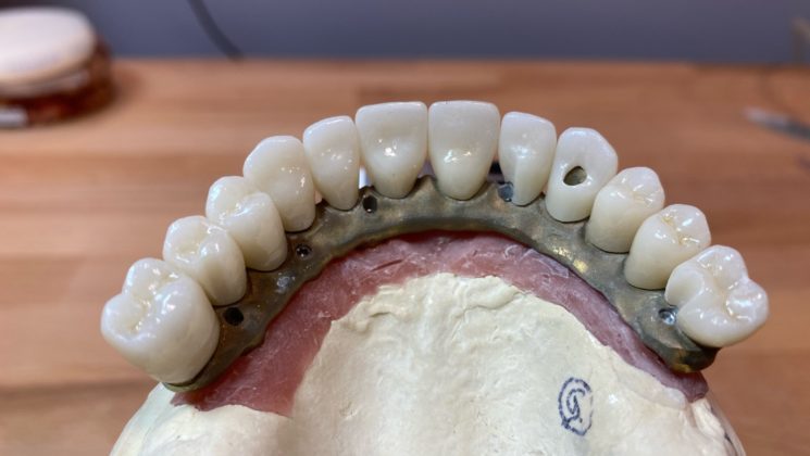 Products - Peterson Dental Laboratory