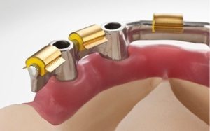 Hader Bar Overdenture - Peterson Dental Laboratory