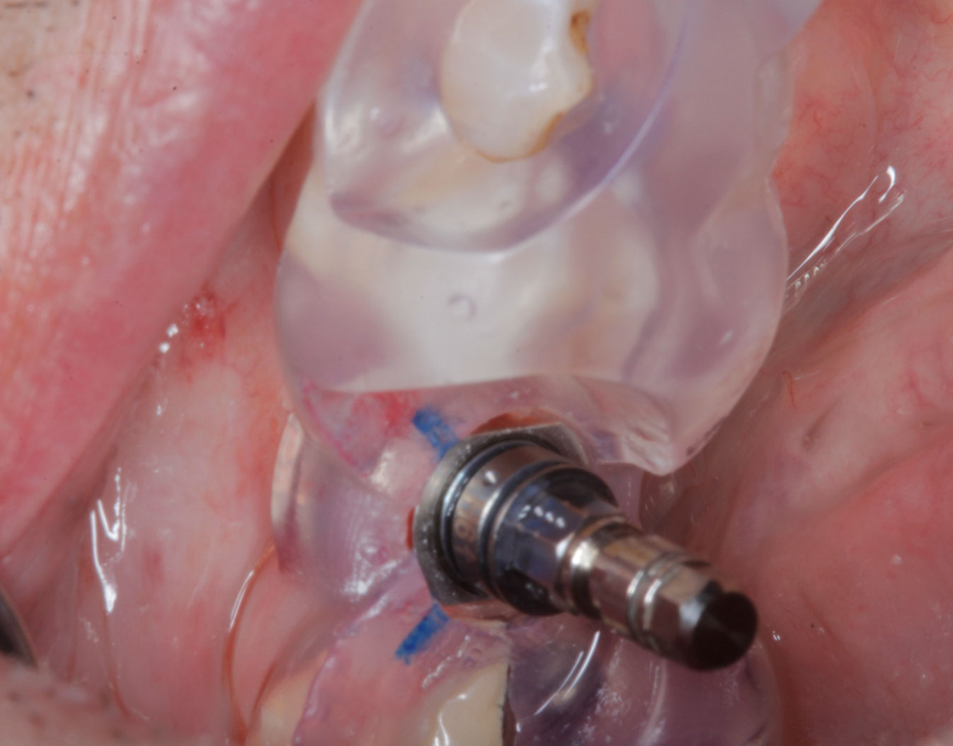 Tooth Supported Guide - Peterson Dental Laboratory