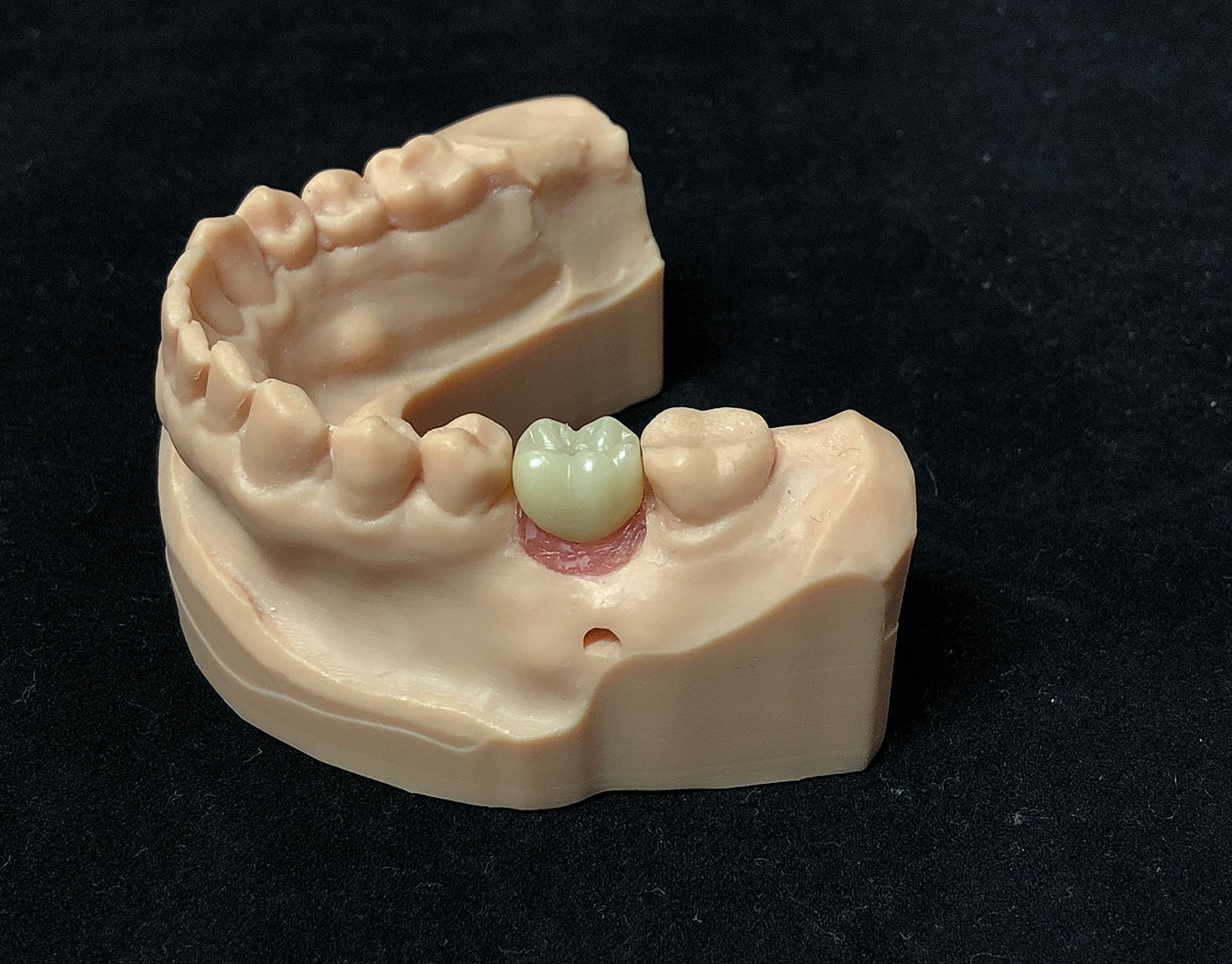 Tooth Supported Guide - Peterson Dental Laboratory