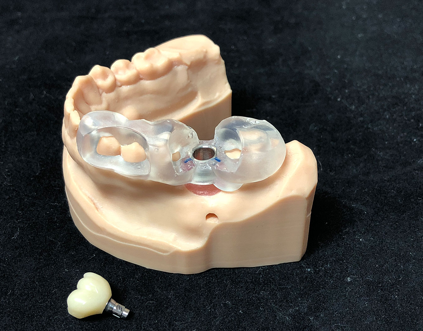 Tooth Supported Guide - Peterson Dental Laboratory